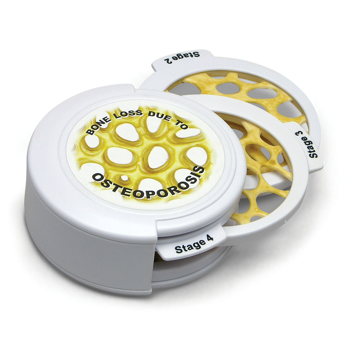 Osteoporosis Model – GPI 3D Anatomy