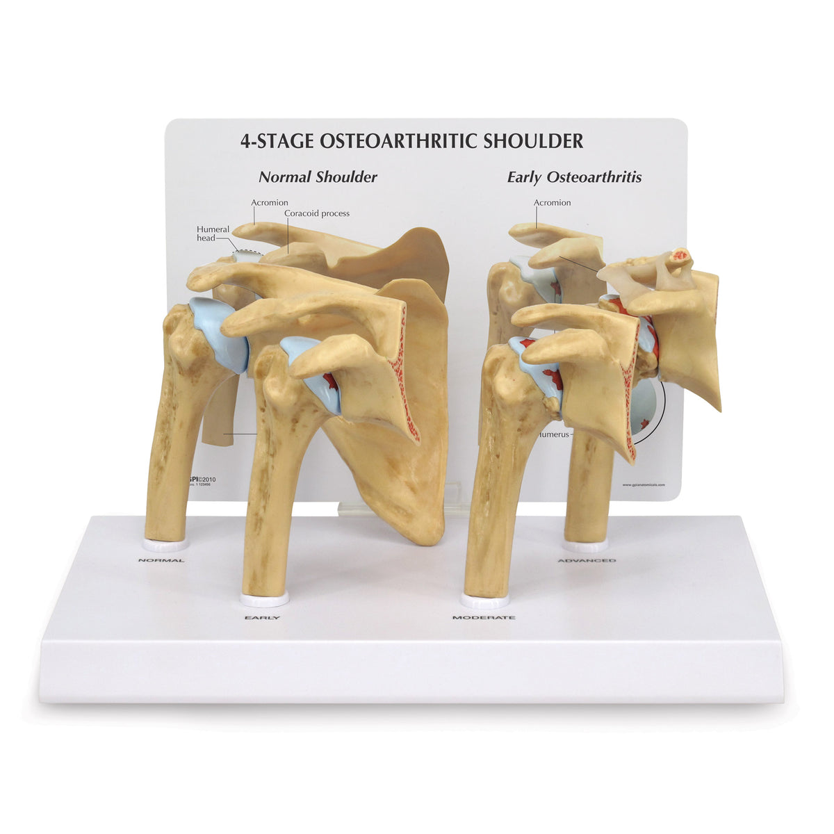 4-Stage Osteoarthritis (OA) Shoulder Model – GPI 3D Anatomy