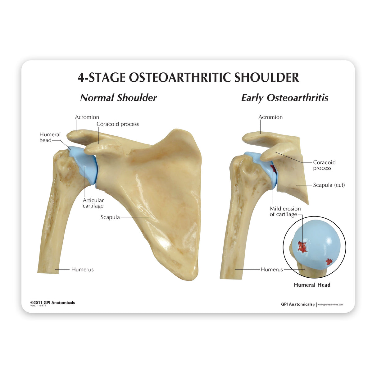 4-Stage Osteoarthritis (OA) Shoulder Model – GPI 3D Anatomy