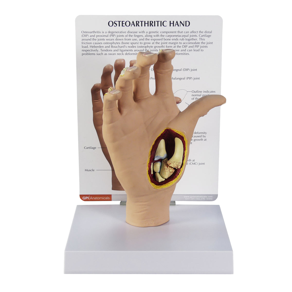 Right Hand Model with Osteoarthritis (OA) – GPI 3D Anatomy