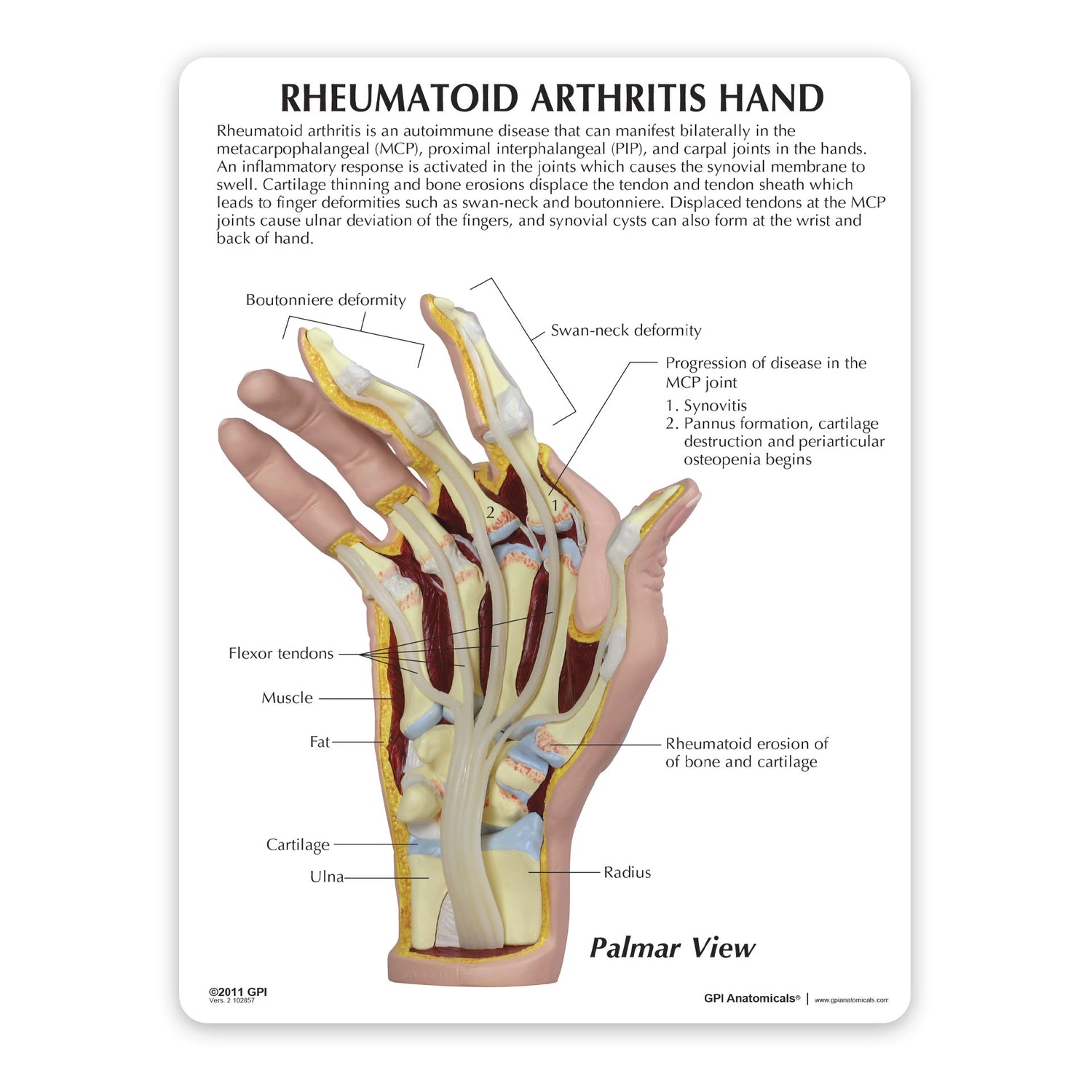 Right Hand Model with Rheumatoid Arthritis – GPI 3D Anatomy