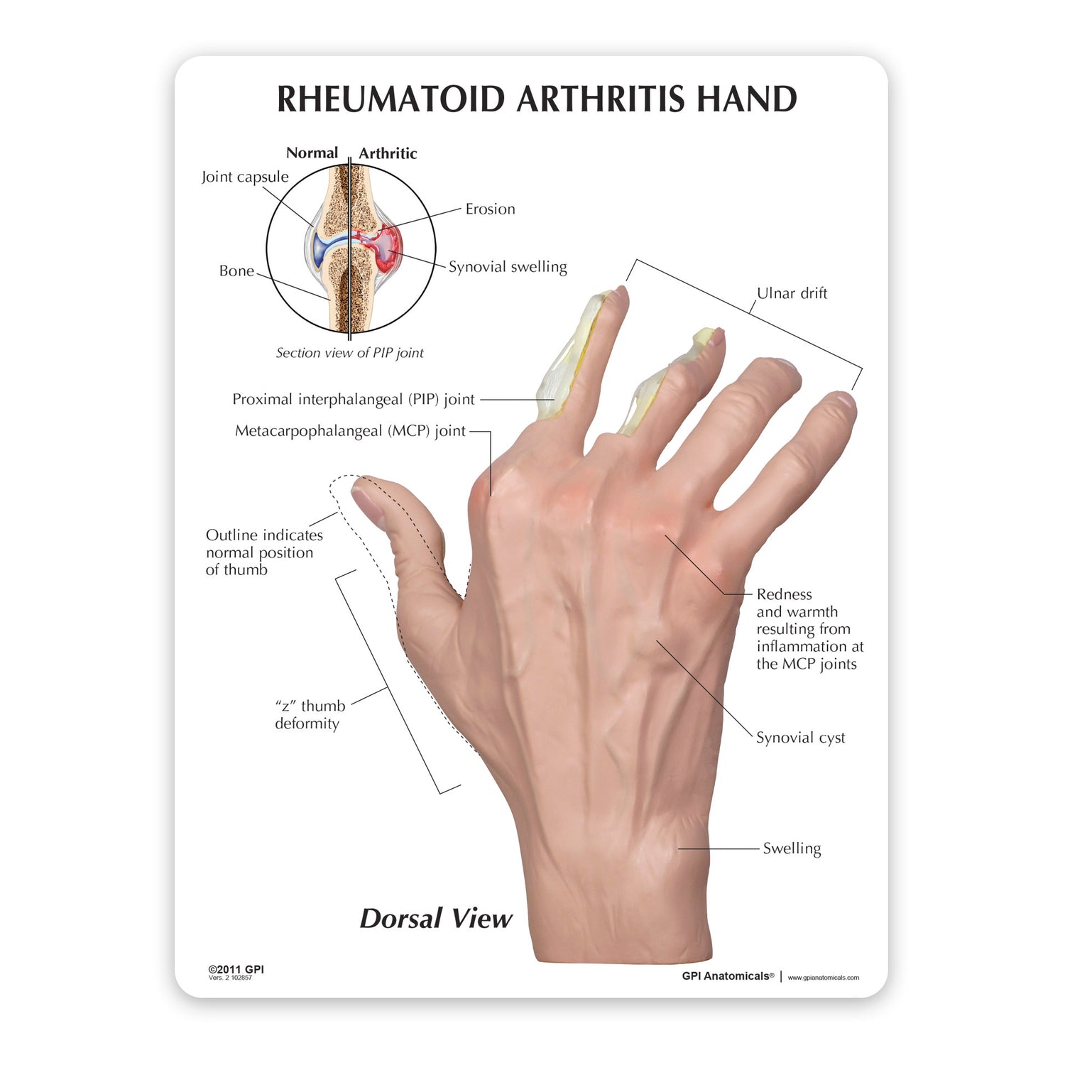 Right Hand Model with Rheumatoid Arthritis – GPI 3D Anatomy