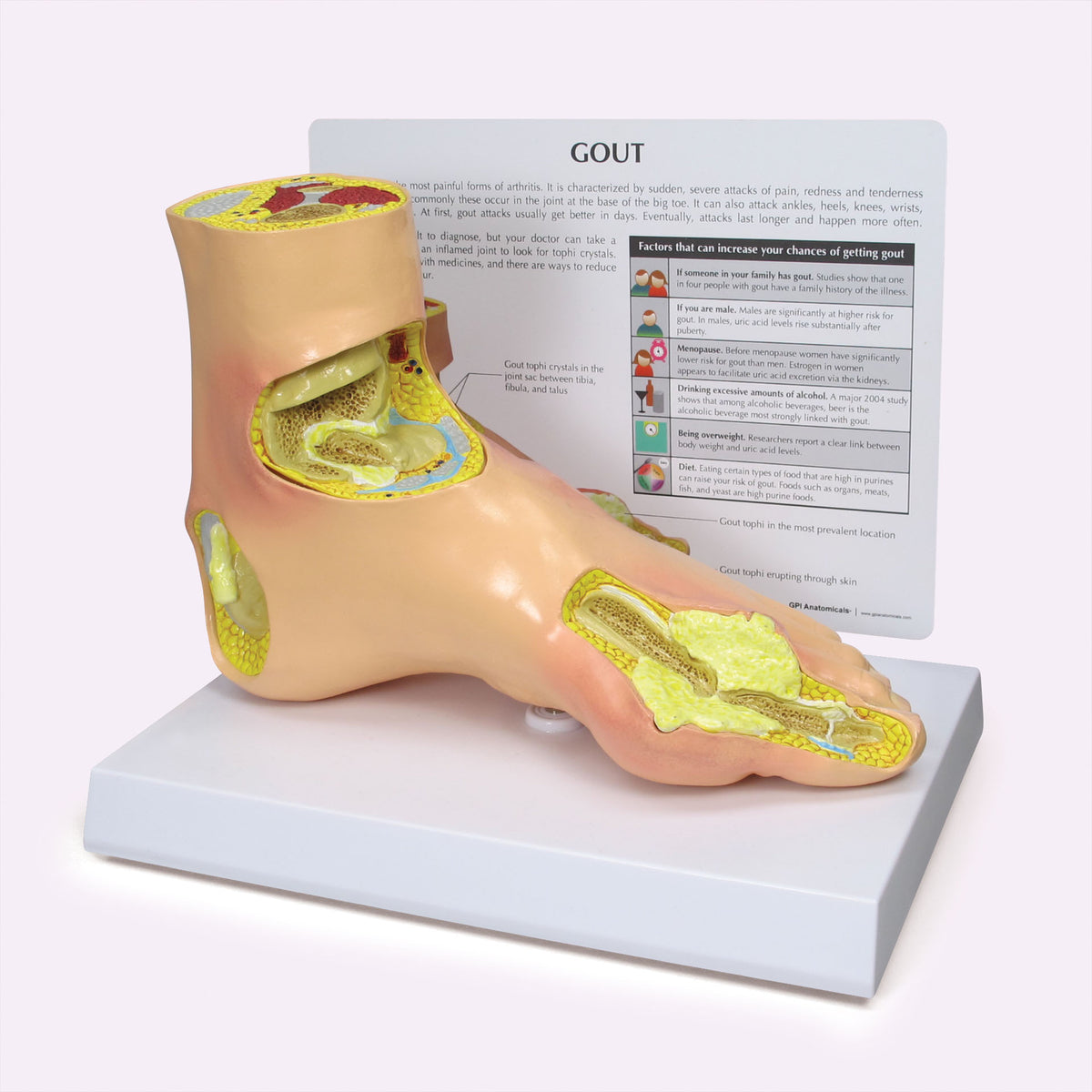 Left Foot Model with Gout – GPI 3D Anatomy