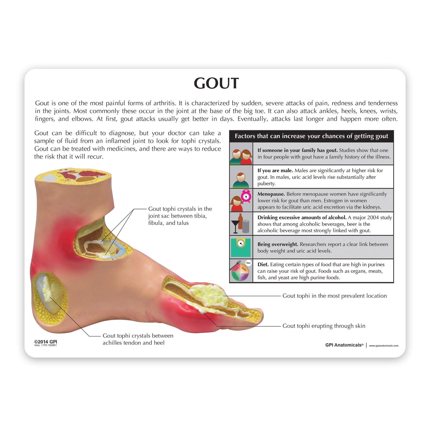 Left Foot Model with Gout – GPI 3D Anatomy