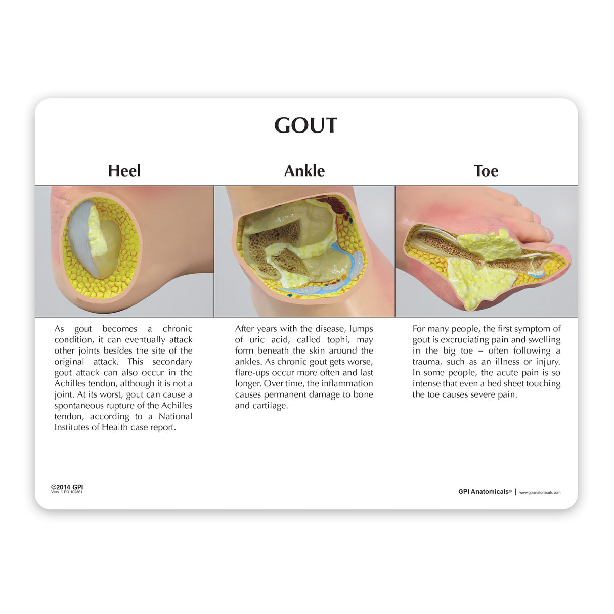Left Foot Model with Gout – GPI 3D Anatomy