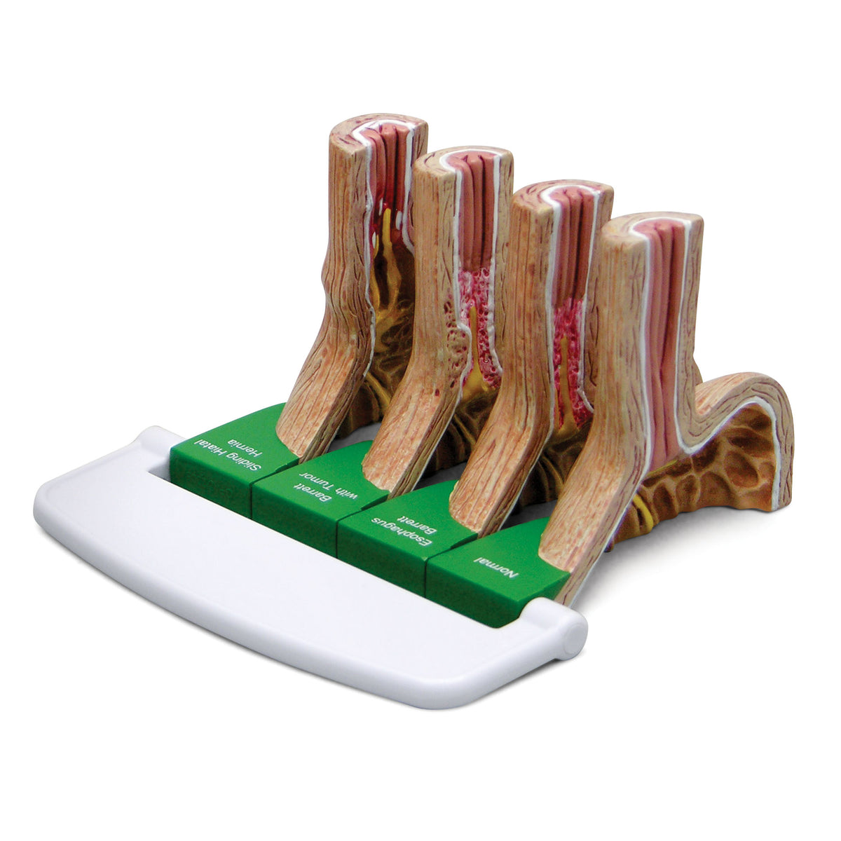 4-Piece Stomach Model Set with Gastroesophageal Reflux Disease (GERD ...