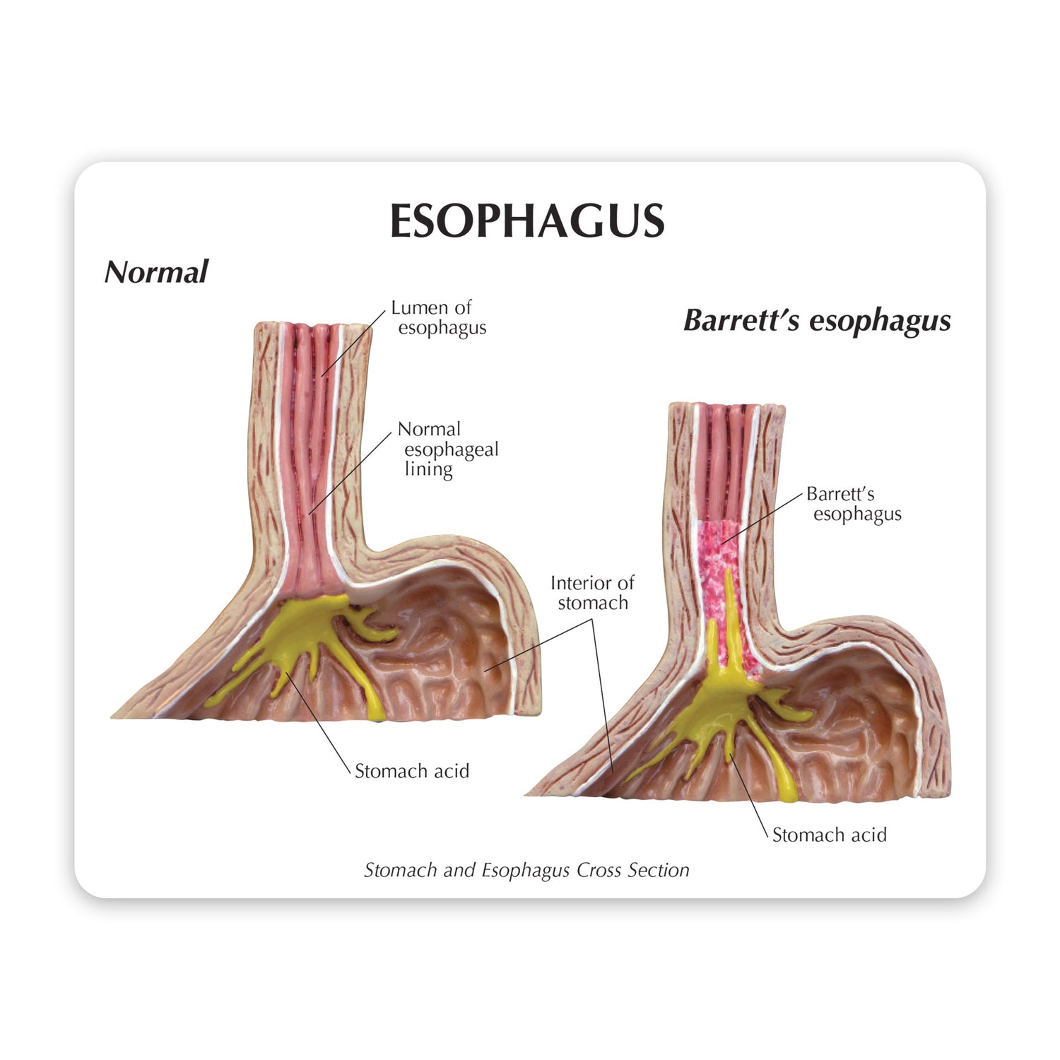 4-Piece Stomach Model Set with Gastroesophageal Reflux Disease (GERD ...