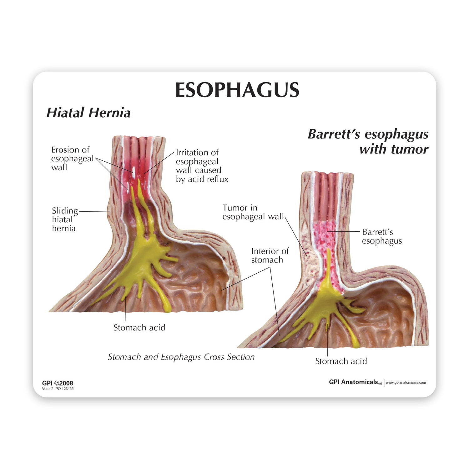 4-Piece Stomach Model Set with Gastroesophageal Reflux Disease (GERD ...