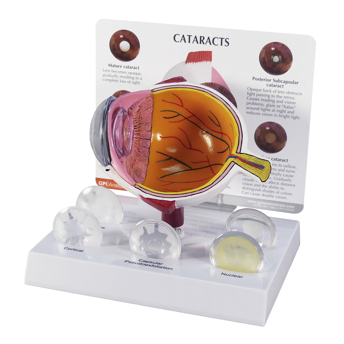 Cataract Eye Model – GPI 3D Anatomy
