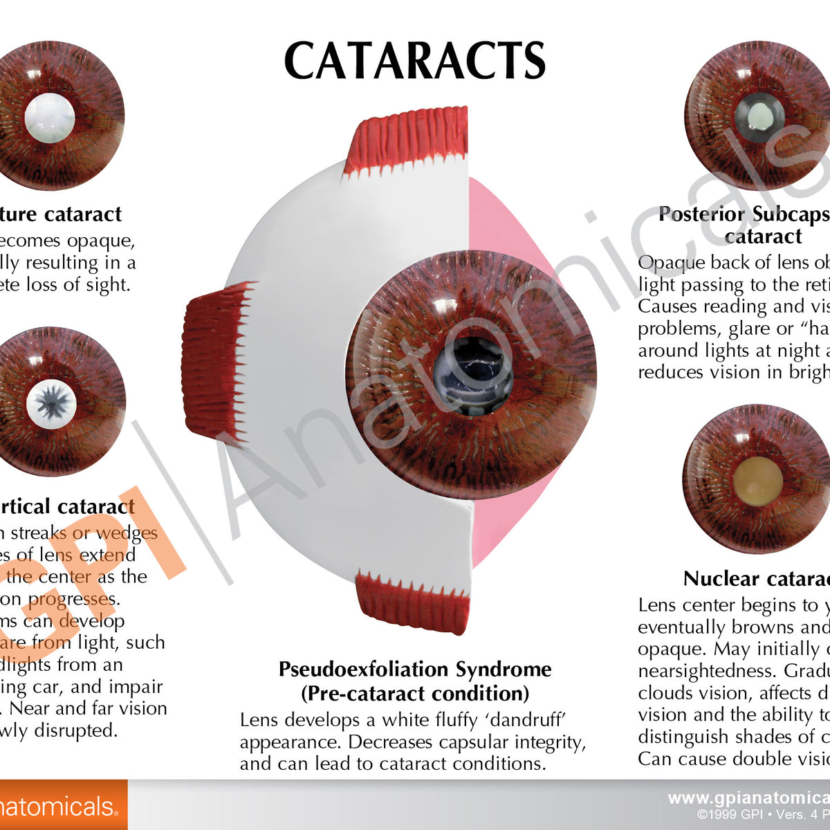 Cataract Eye Education Card – GPI 3D Anatomy