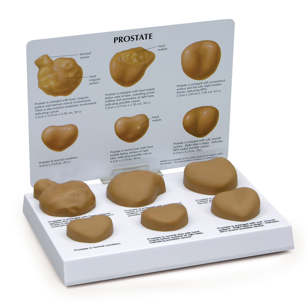 Prostate With Conditions Model Set Gpi 3d Anatomy