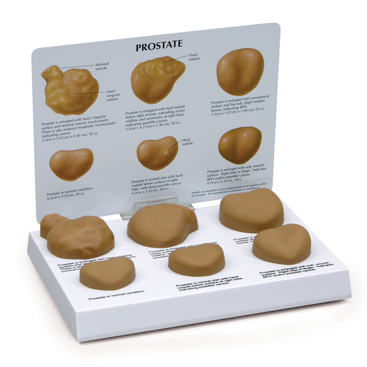 Prostate with Conditions Model Set – GPI 3D Anatomy