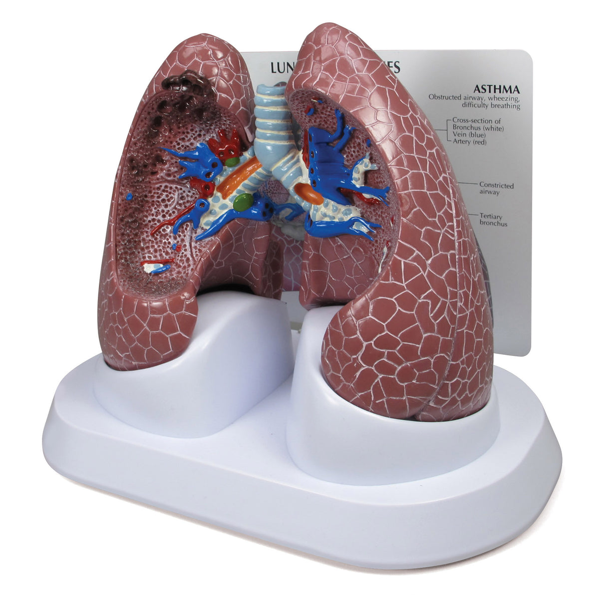 Lung Model Set with Pathologies – GPI 3D Anatomy
