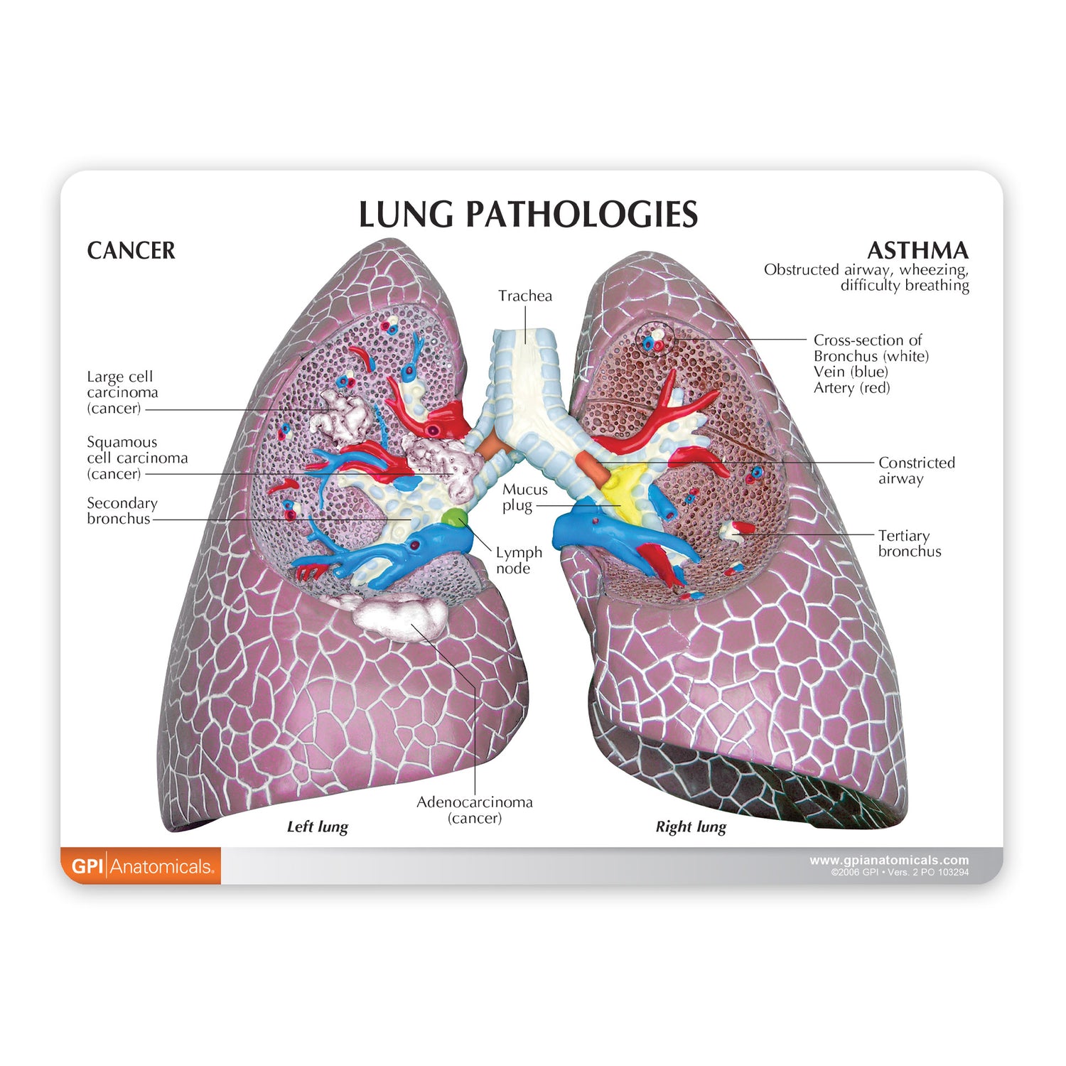 Lung Model Set with Pathologies – GPI 3D Anatomy