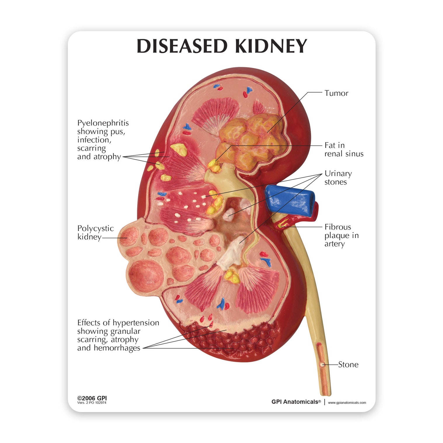 Normal and Diseased Kidney Model – GPI 3D Anatomy