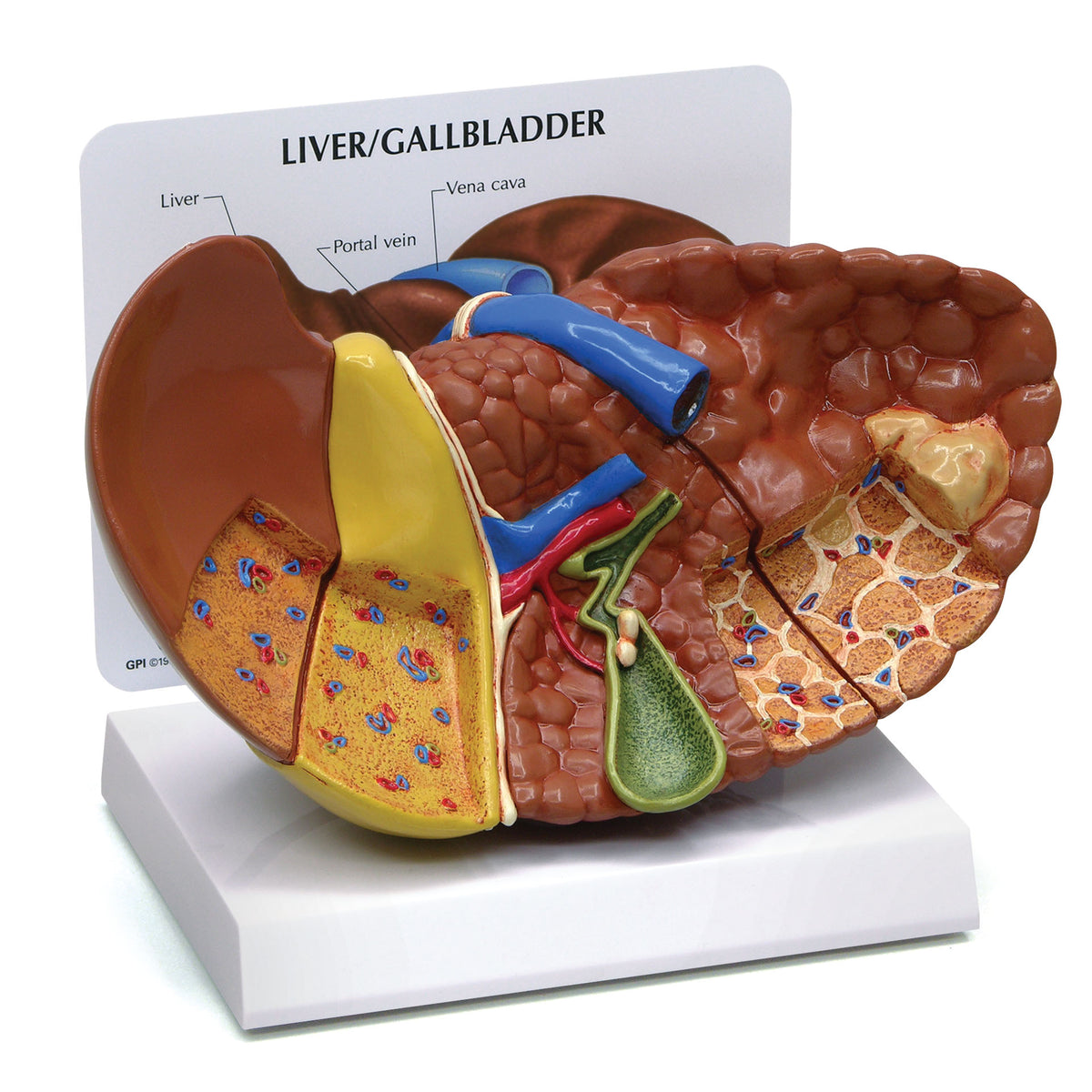 Liver Model with Common Pathologies – GPI 3D Anatomy