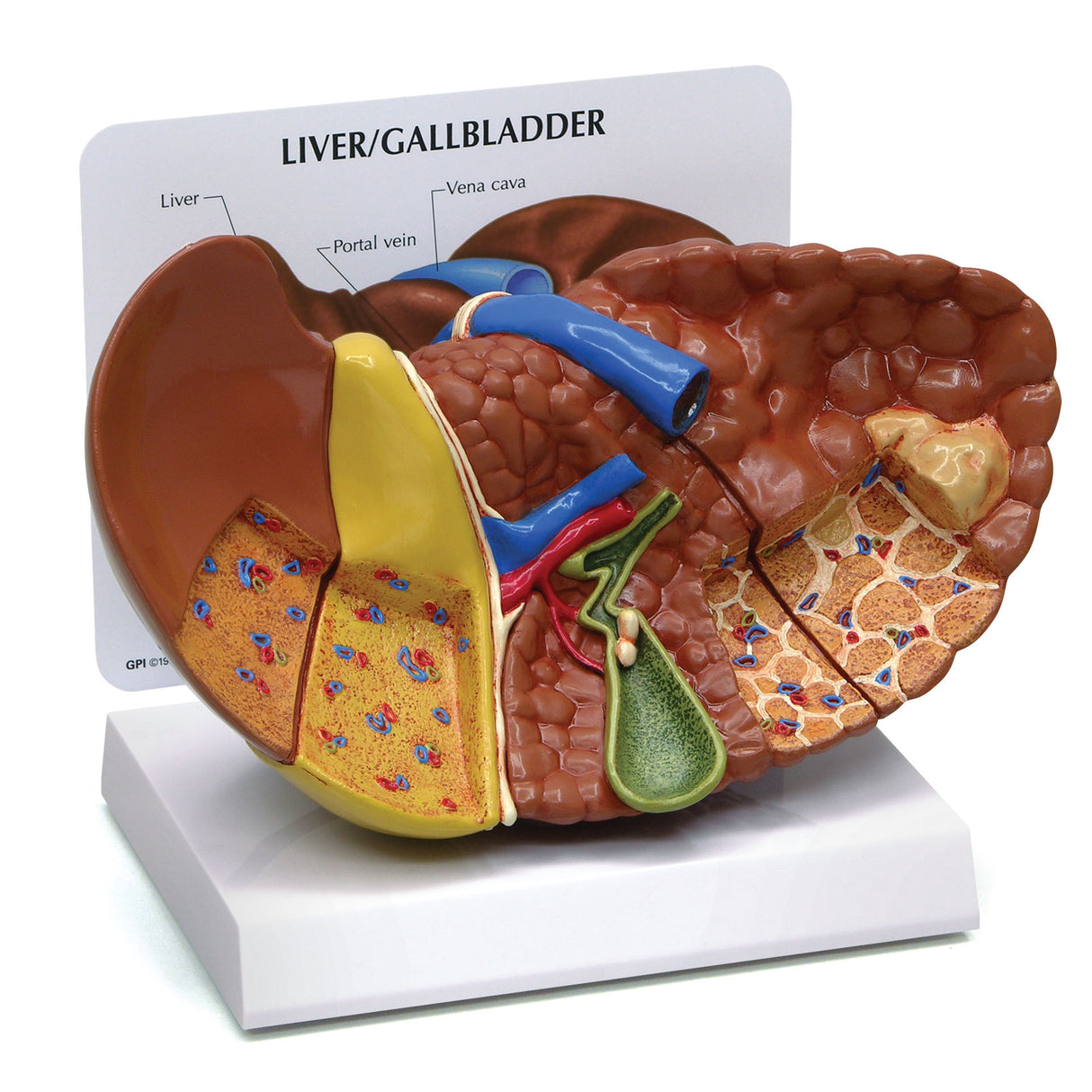 Liver Model with Common Pathologies – GPI 3D Anatomy