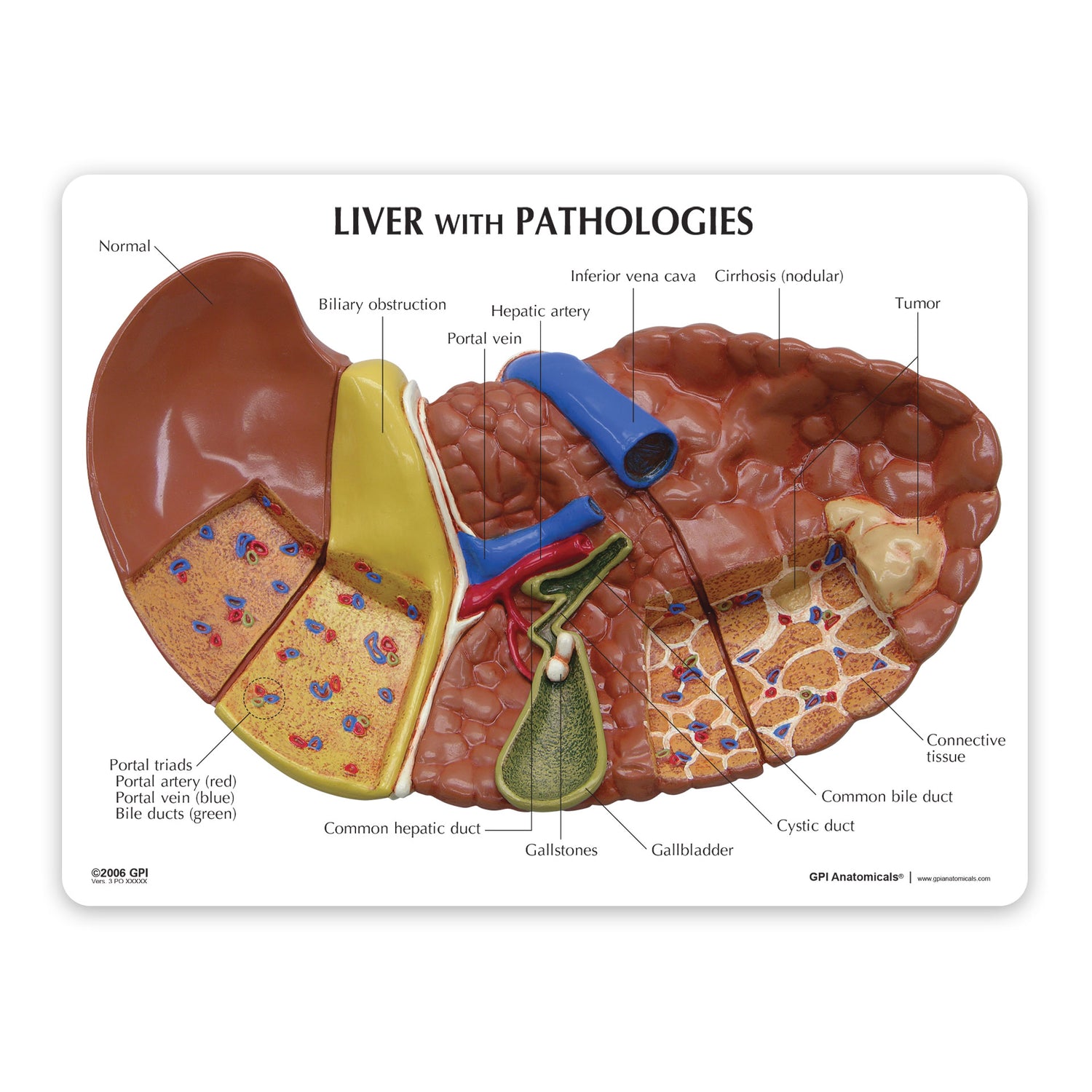 Liver Model with Common Pathologies – GPI 3D Anatomy
