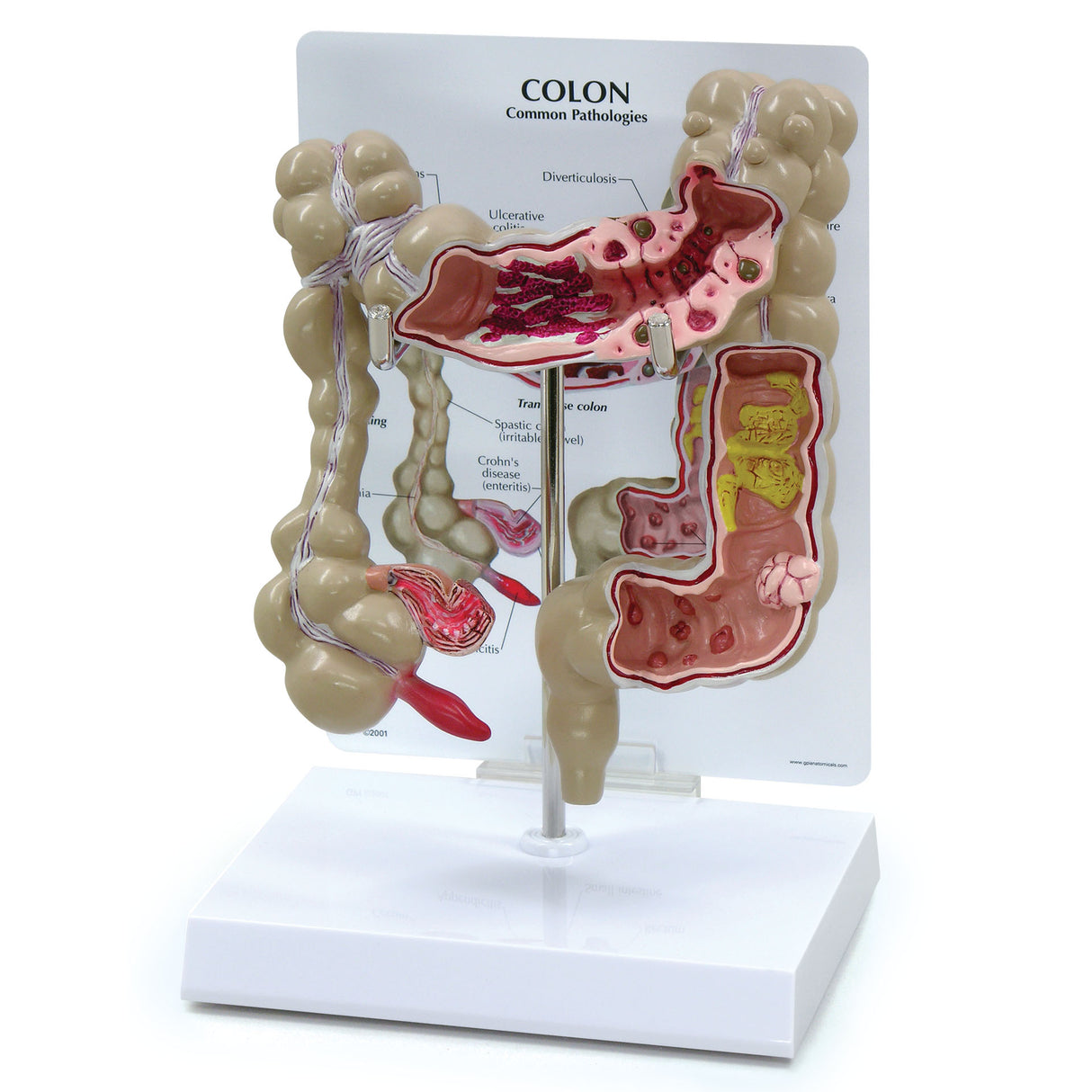 Colon Model with Common Pathologies – GPI 3D Anatomy