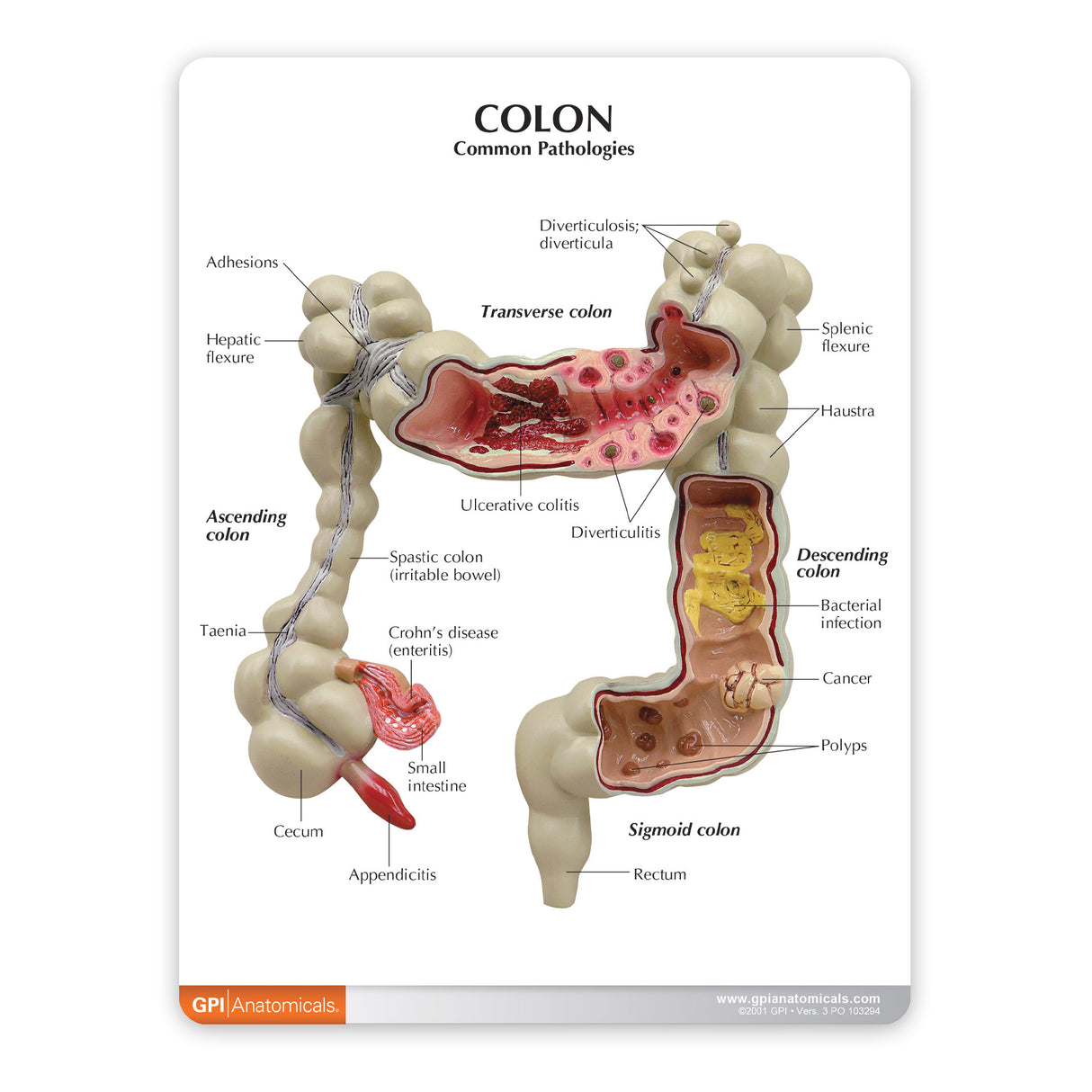 Colon Model with Common Pathologies – GPI 3D Anatomy