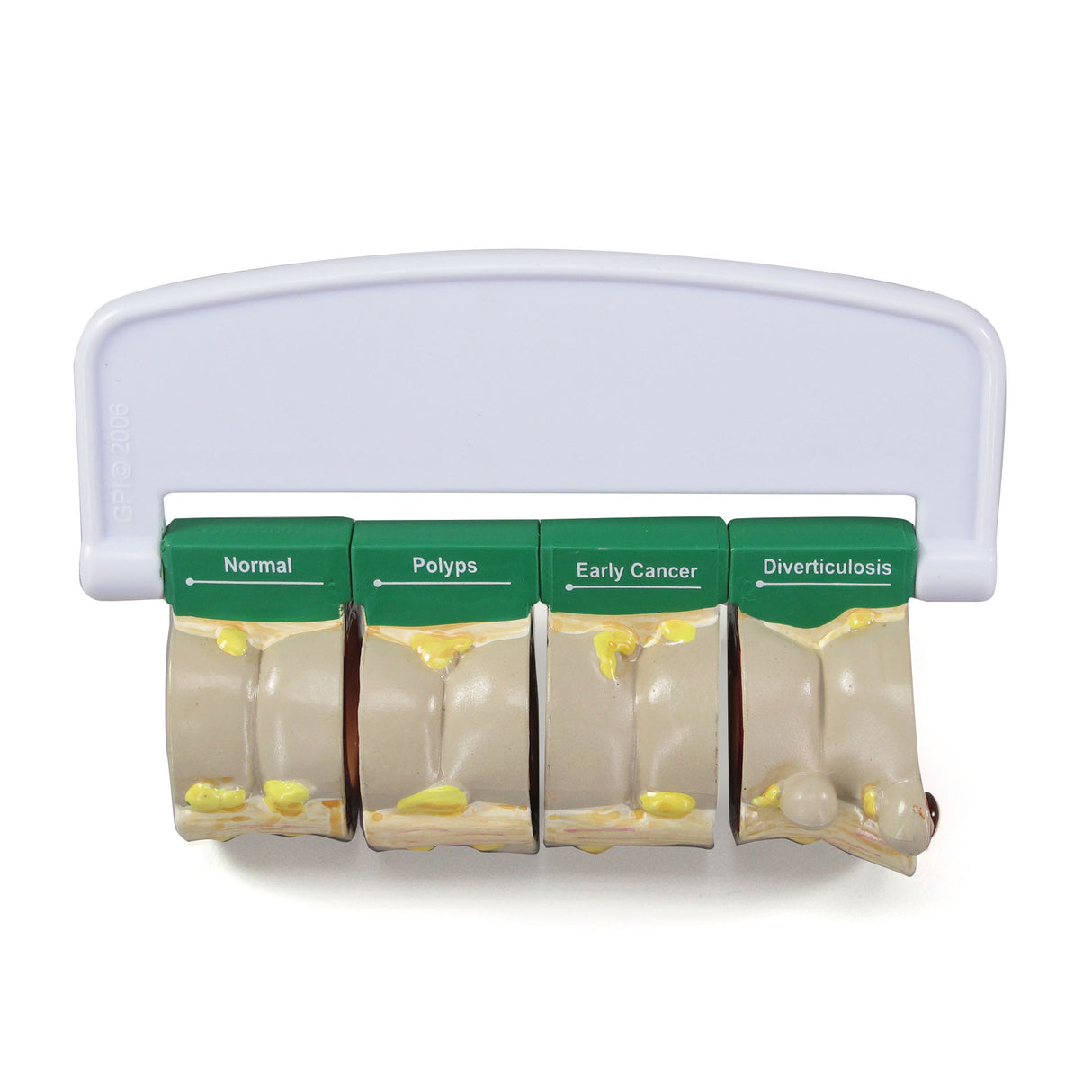 4-Piece Colon Model Set with Pathologies – GPI 3D Anatomy