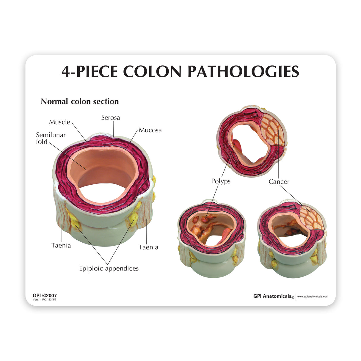 4-Piece Colon Model Set with Pathologies – GPI 3D Anatomy