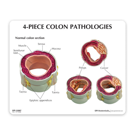 4-Piece Colon Model Set with Pathologies – GPI 3D Anatomy