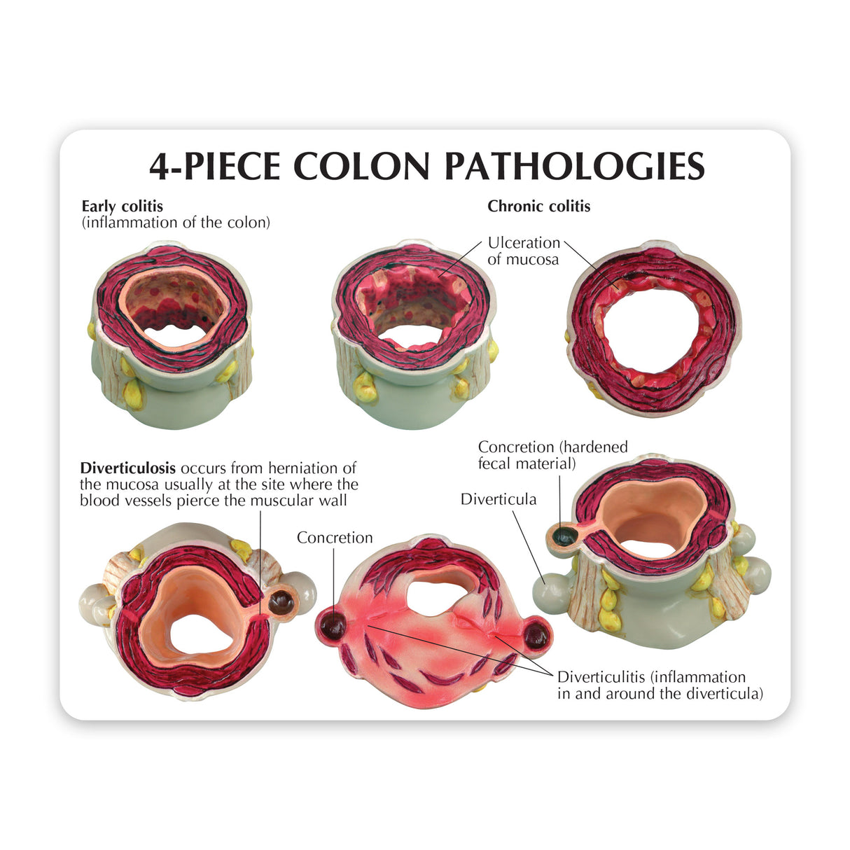 4-Piece Colon Model Set with Pathologies – GPI 3D Anatomy