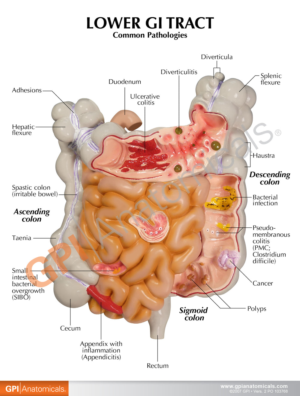 GI Tract Model with Common Pathologies – GPI 3D Anatomy