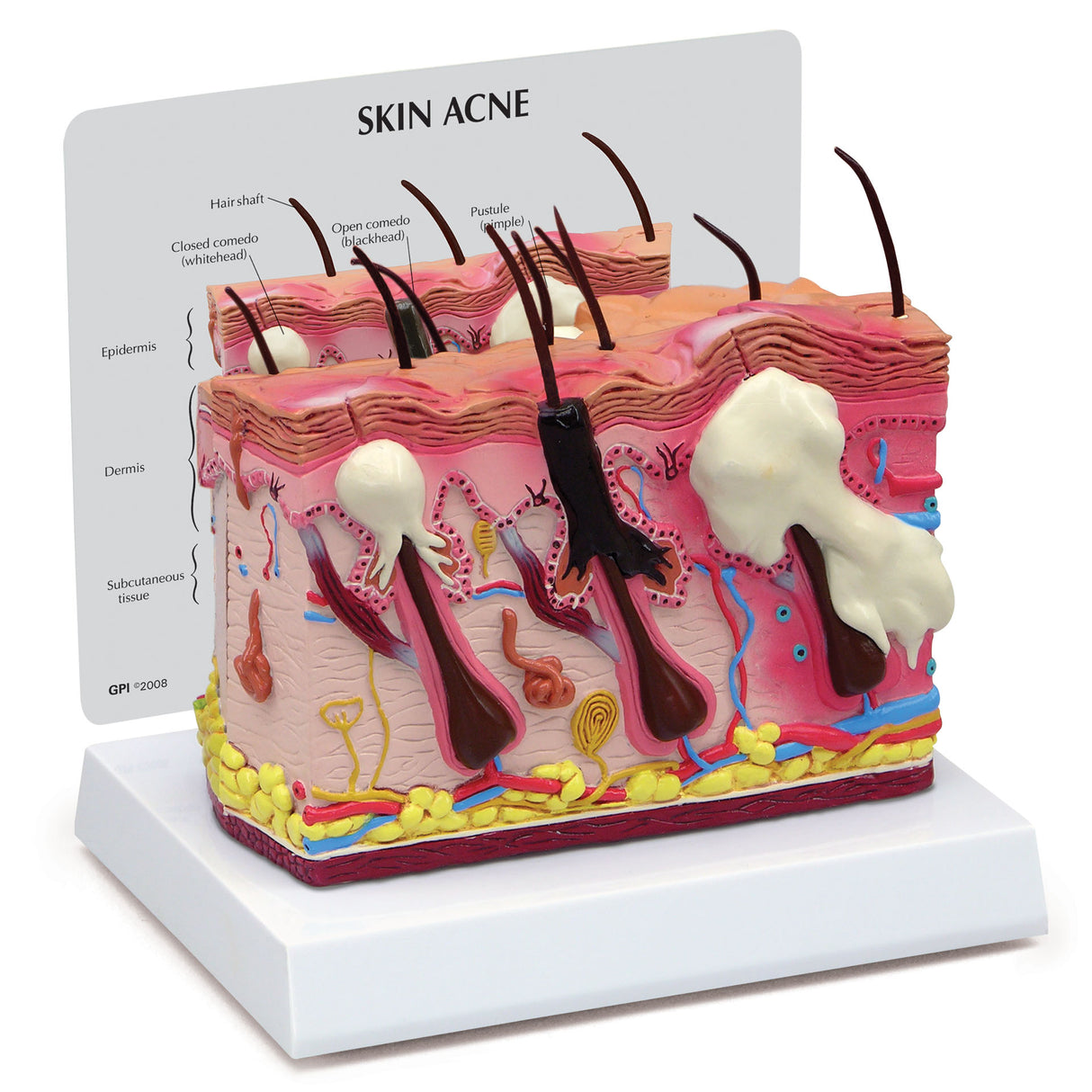 Skin Acne Cross-Section Model – GPI 3D Anatomy