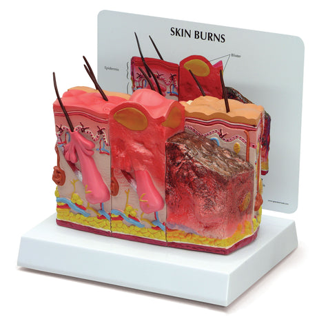 Skin Burn Education Card – GPI 3D Anatomy