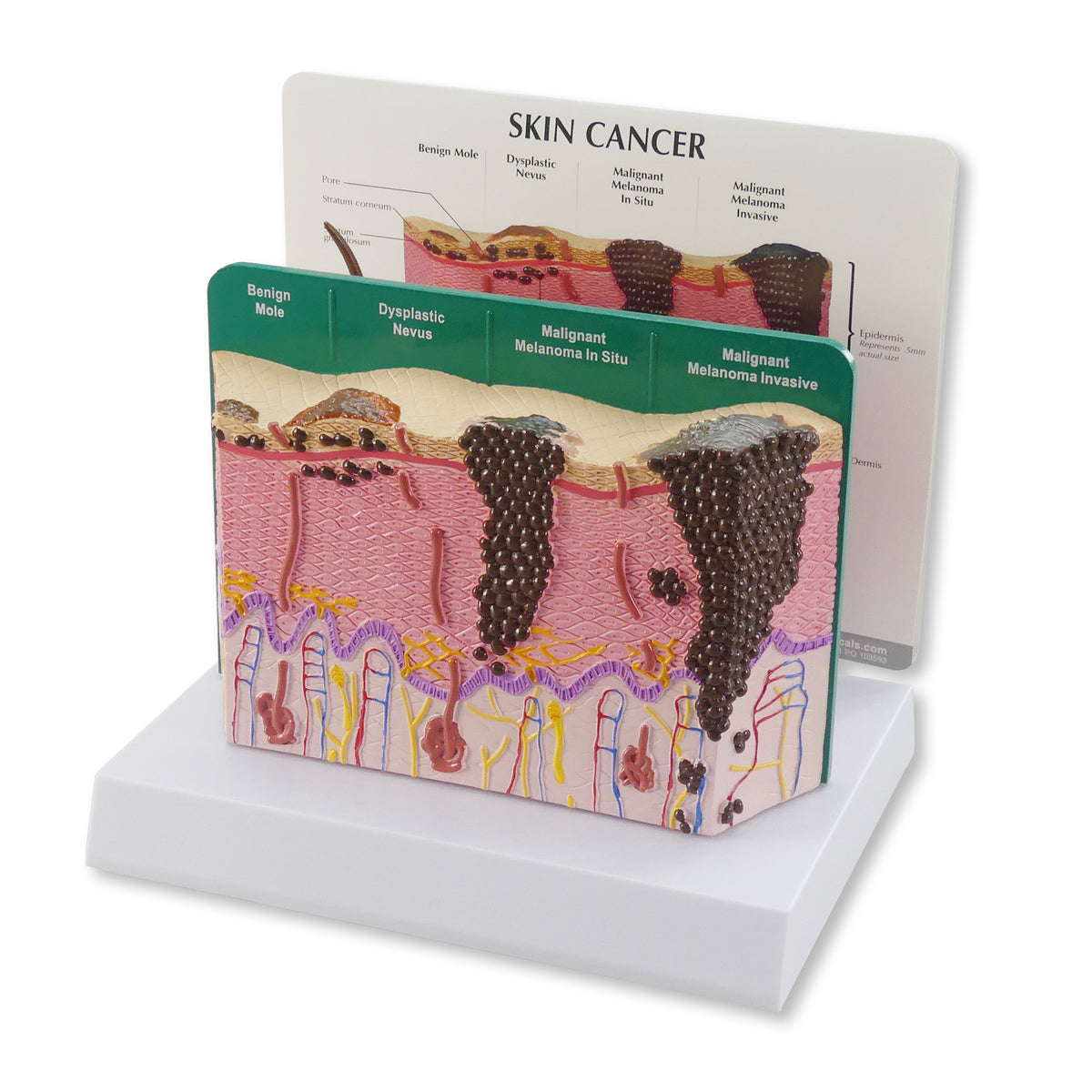 Melanoma Skin Cancer – GPI 3D Anatomy