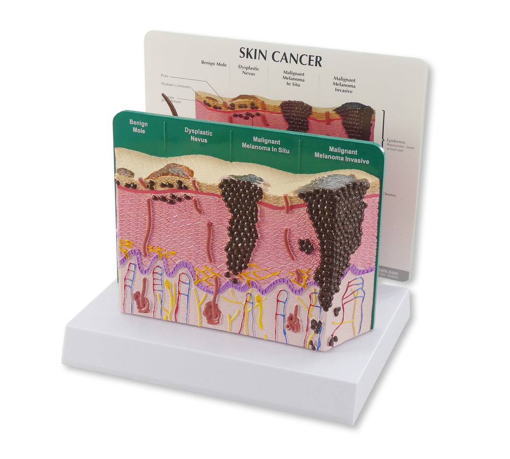 Skin Cancer Model – GPI 3D Anatomy