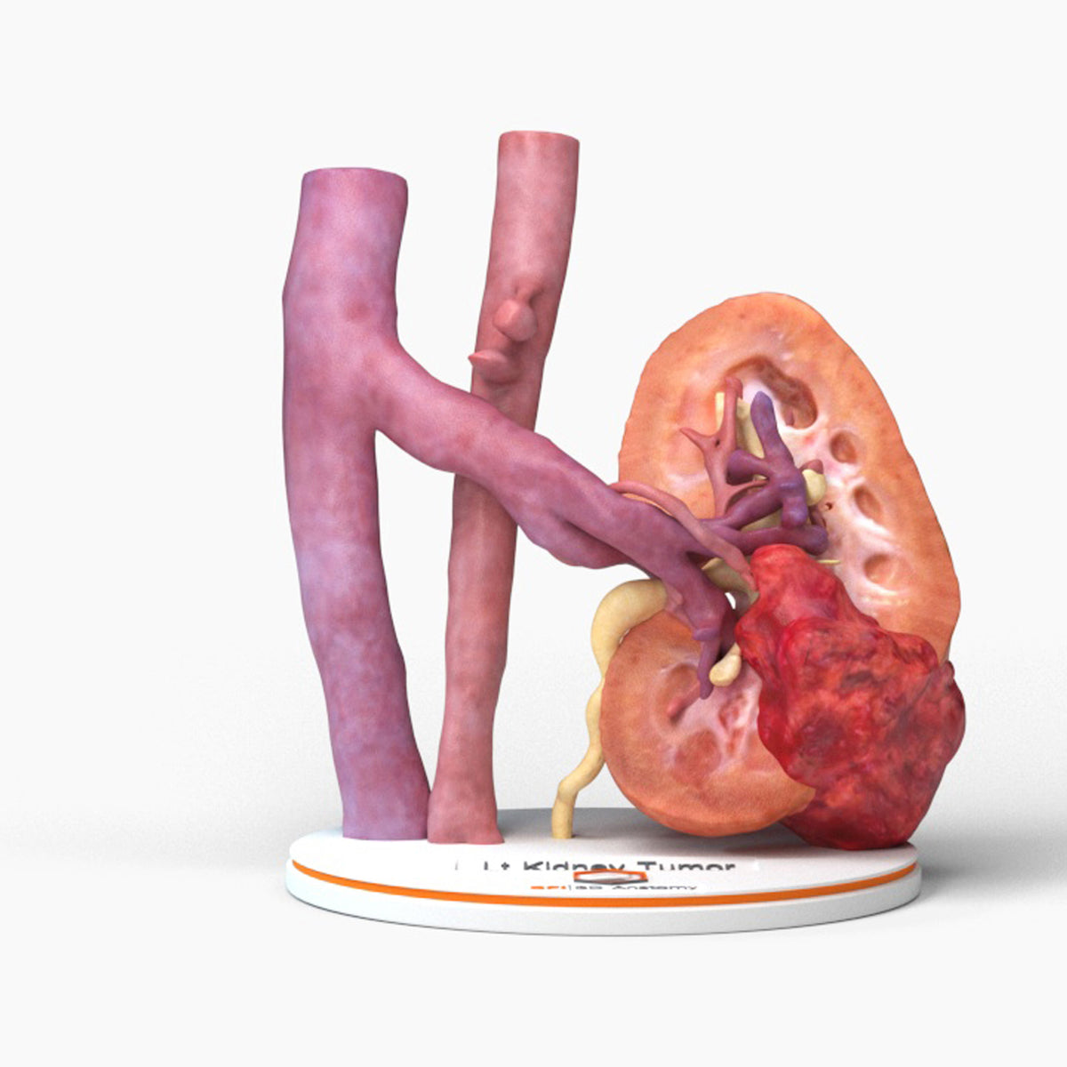 Realistic Left Kidney with Kidney Cancer | Custom 3D Anatomy Models ...