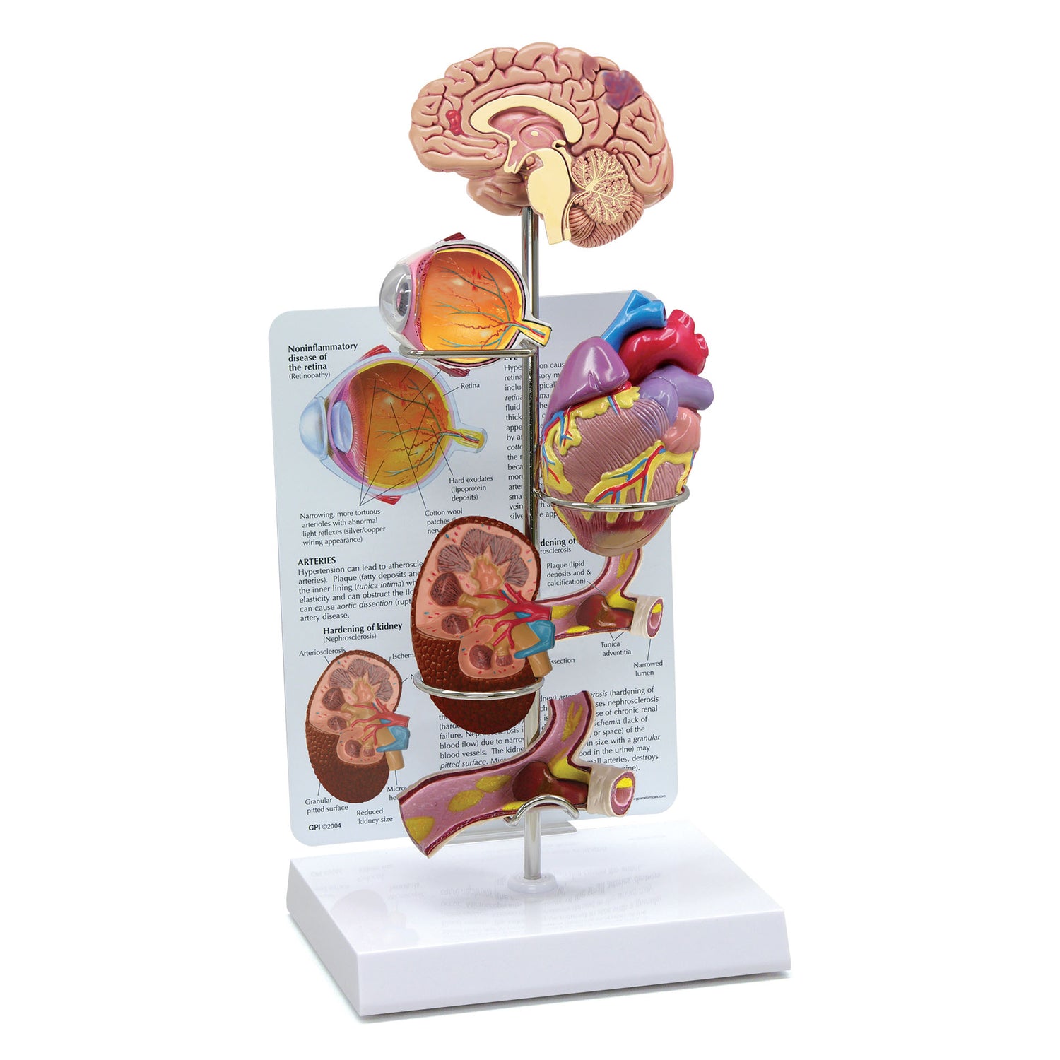 Hypertension Model Set – GPI 3D Anatomy