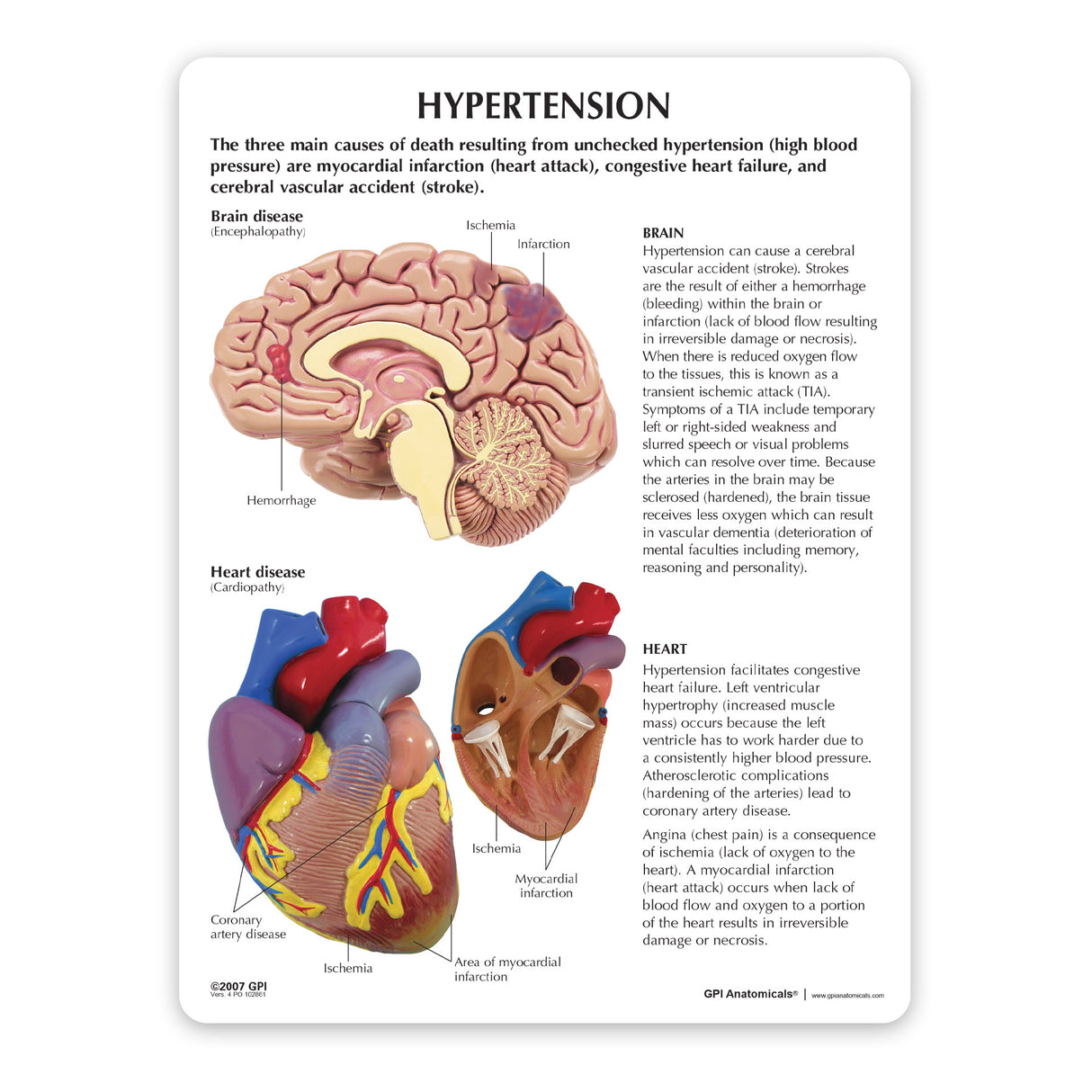 Hypertension Model Set – GPI 3D Anatomy
