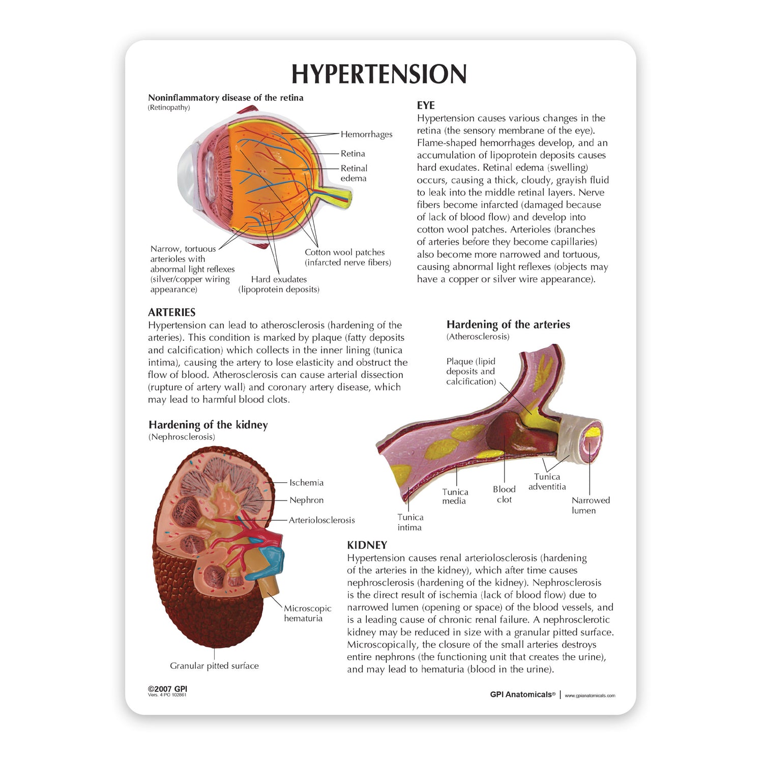 Hypertension Model Set – GPI 3D Anatomy