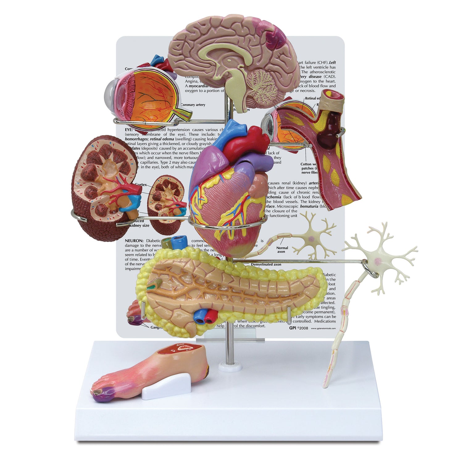 Type II Diabetes Model Set – GPI 3D Anatomy