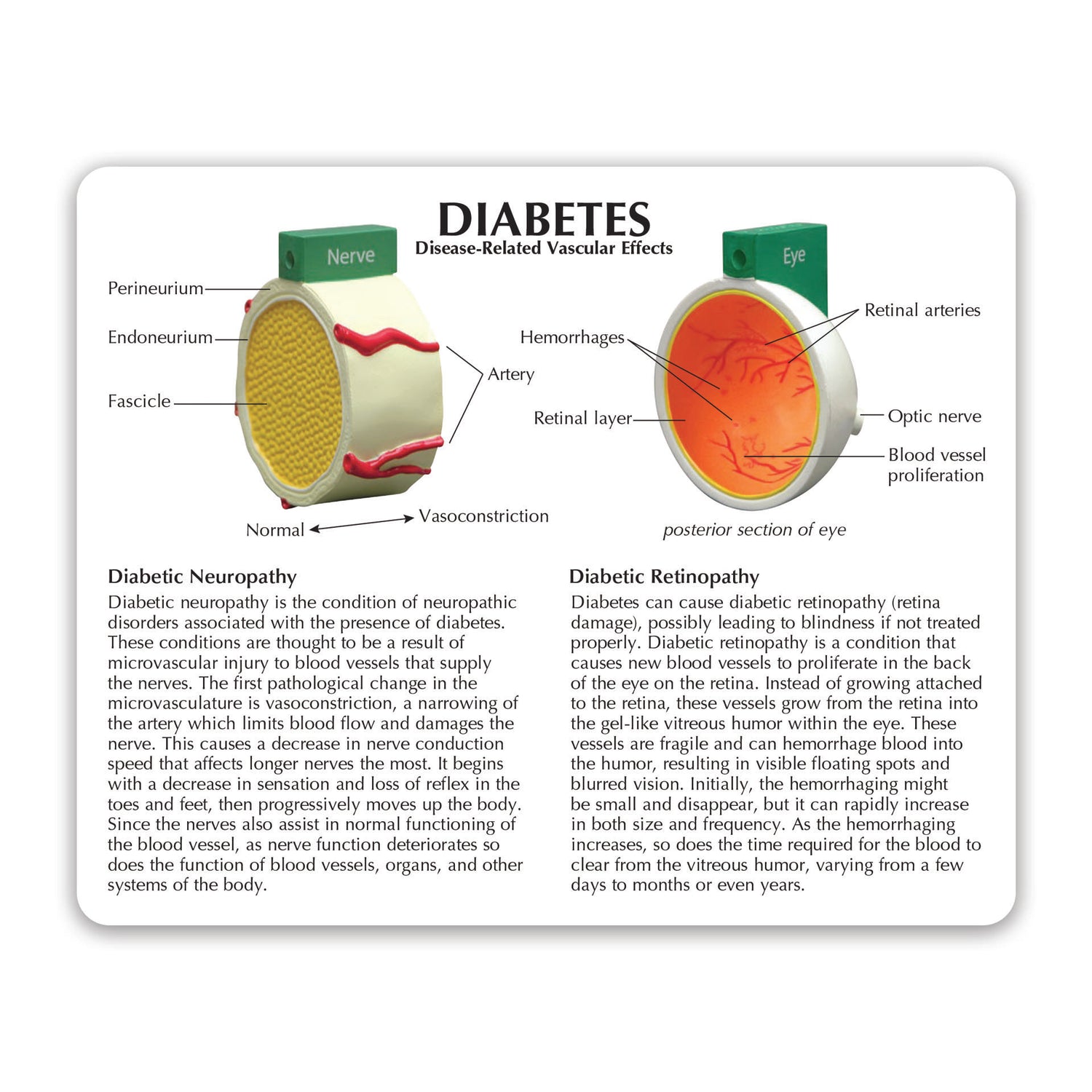 4-Piece Diabetes Model – GPI 3D Anatomy