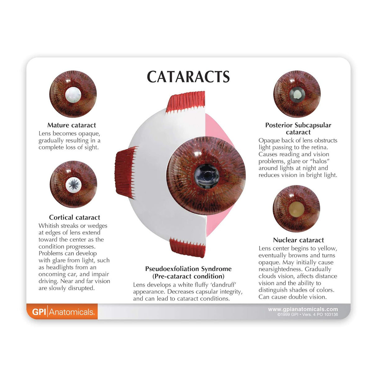 Cataract Eye Education Card – GPI 3D Anatomy