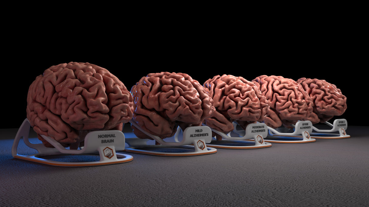 Custom 3D Anatomy Models | Adult Brain | Alzheimer’s Disease | Dementia ...