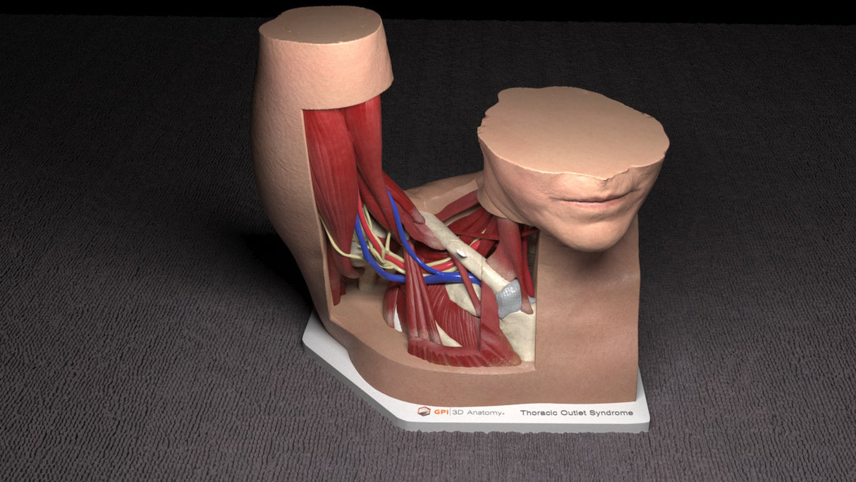 Custom 3D Anatomy Models | Thoracic Outlet Syndrome (TOS) | Thoracic ...