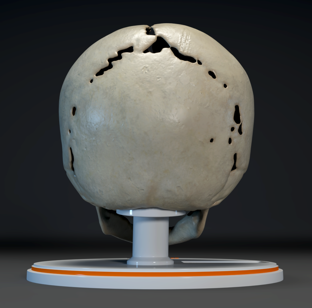 Custom 3D Anatomy Models | Craniosynostosis | Coronal Suture ...