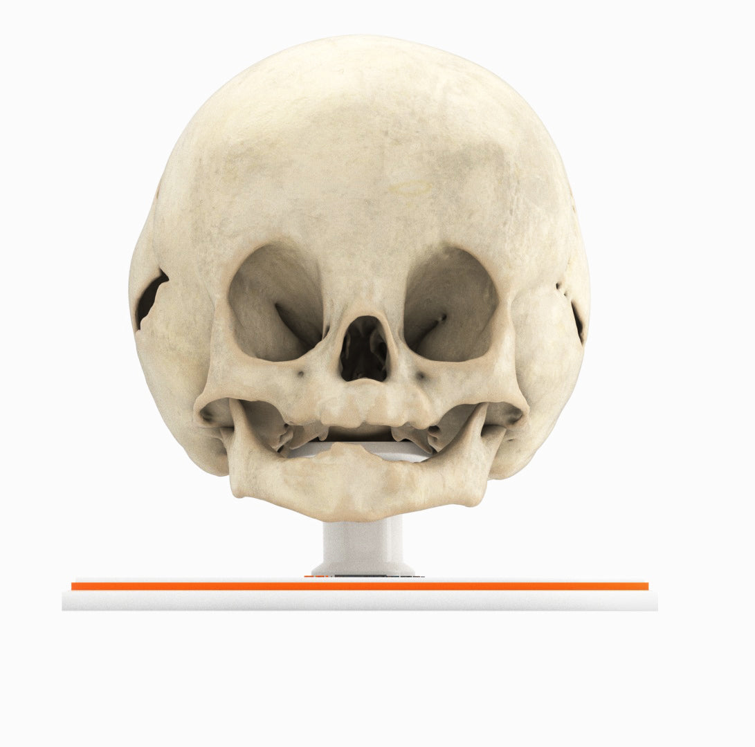 Custom 3D Anatomy Models | Craniosynostosis | Lambdoid Suture ...