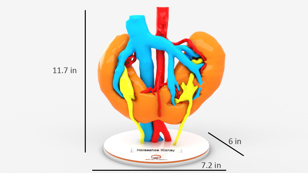 Custom 3D Anatomy Models | Renal Cell Carcinoma | Horseshoe Kidney ...