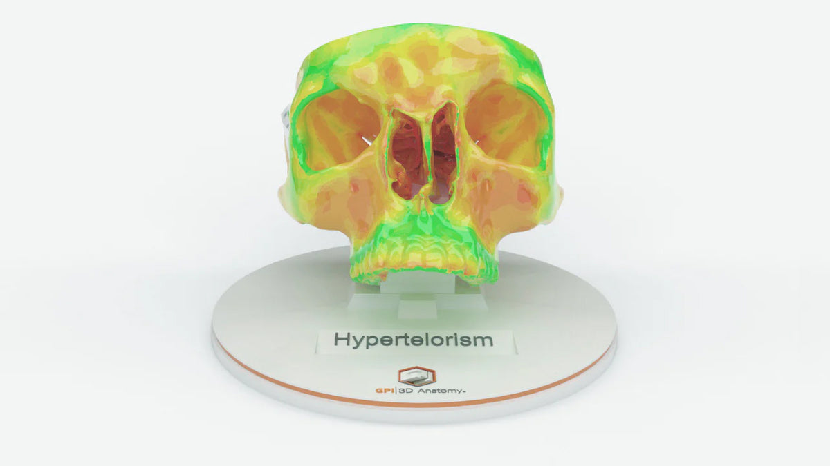 Custom 3D Anatomy Models | Bifid Nose | Hypertelorism – GPI 3D Anatomy