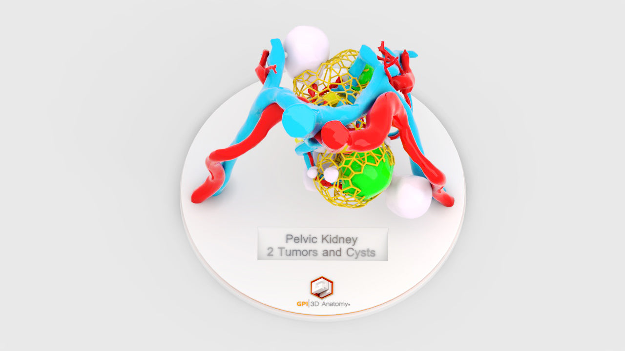 Custom 3D Anatomy Models | Kidney Disease | Kidney Neoplasm | Kidney Cysts – GPI 3D Anatomy