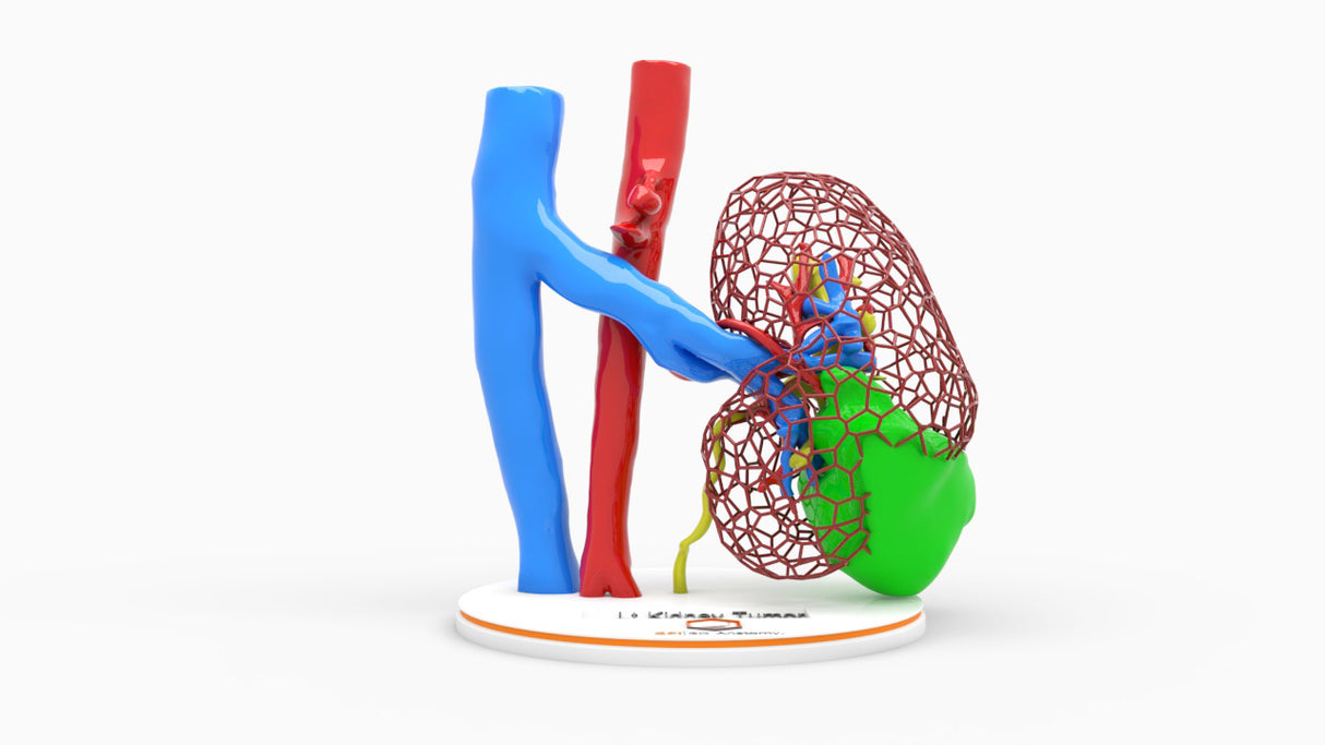 Custom 3D Anatomy Models | Neoplasm | Renal Cancer | Kidney – GPI 3D ...