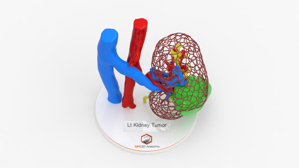 Custom 3D Anatomy Models | Neoplasm | Renal Cancer | Kidney – GPI 3D ...
