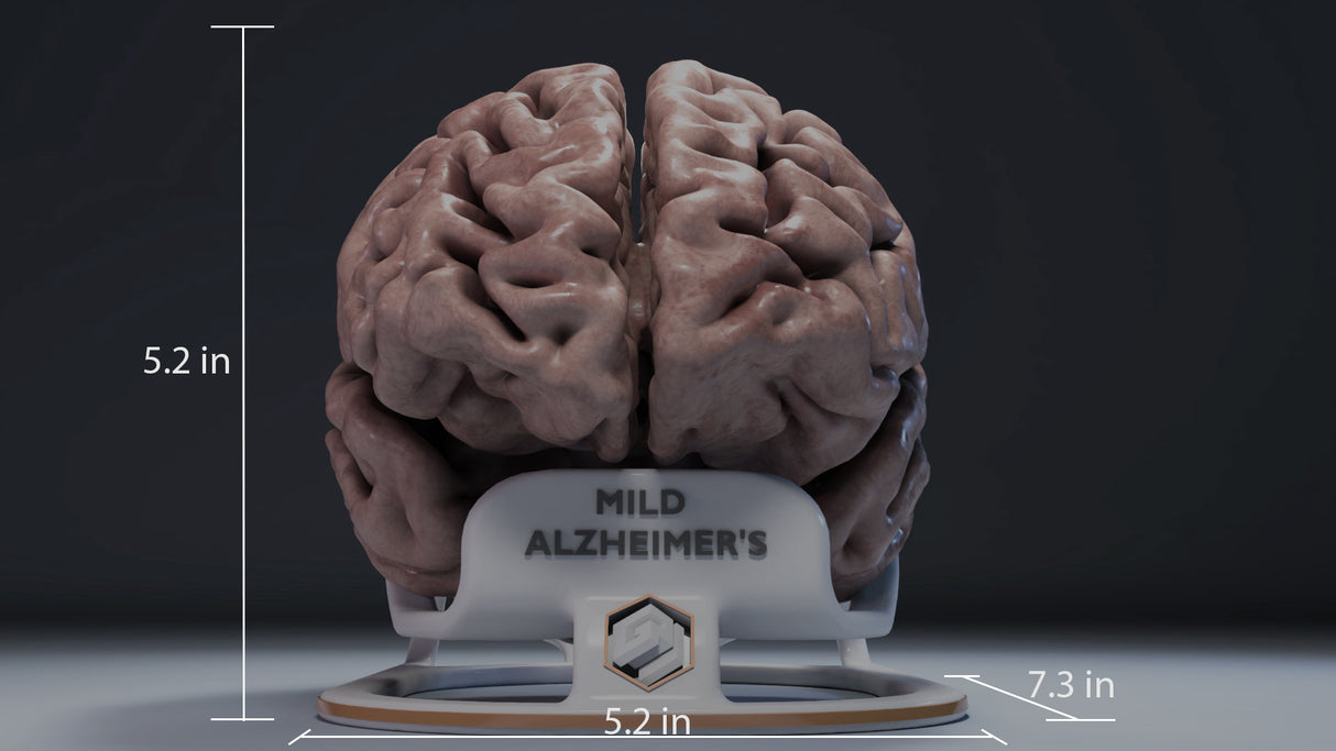 Custom 3D Anatomy Models | Adult Brain | Alzheimer’s Disease | Dementia ...